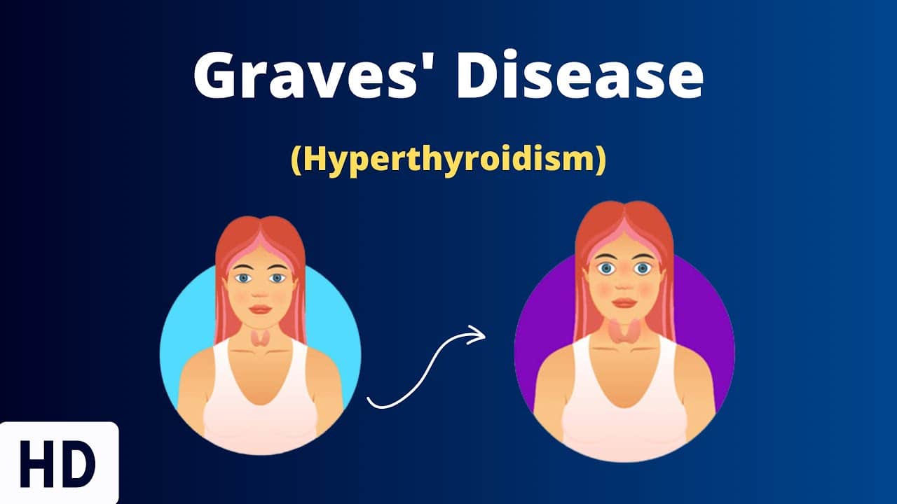 Unveiling graves disease symptoms: what you need to know now!